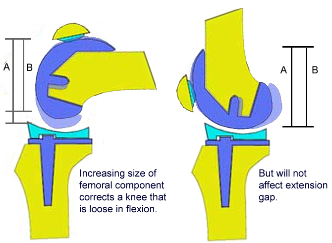 TKA Sagittal Plane Balancing - Recon - Orthobullets